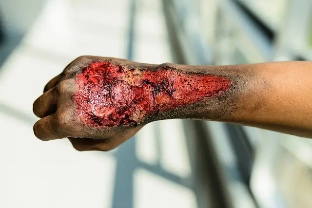 Burn Prevention - ABCS Safety Training Inc.